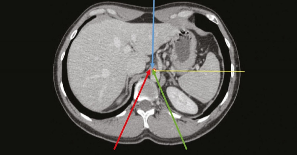 Plexo solar: qué es, características, funciones y patologías asociadas