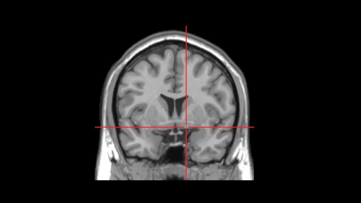 Nucleo Basal Da Secao Transversal De Meynert Cholinergic Stimulation