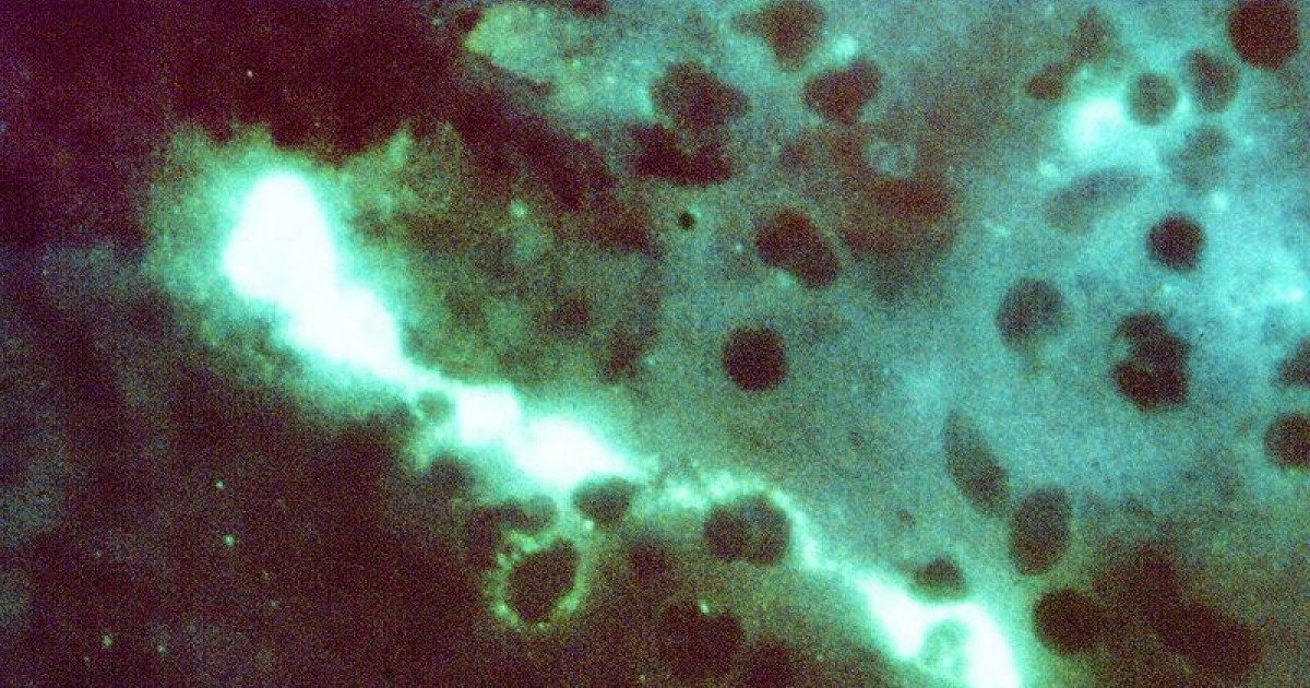 Clamidia: qué es, síntomas, causas y tratamiento de esta ETS