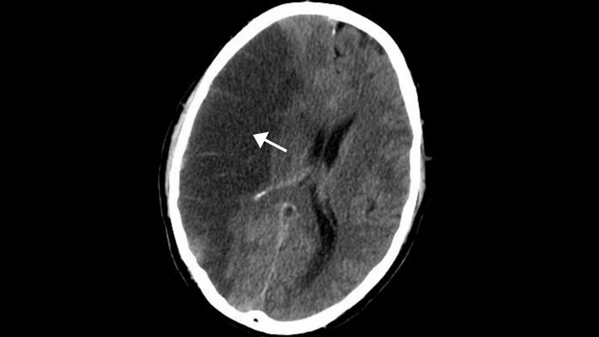 Síntomas De Accidente Cerebrovascular Isquémico