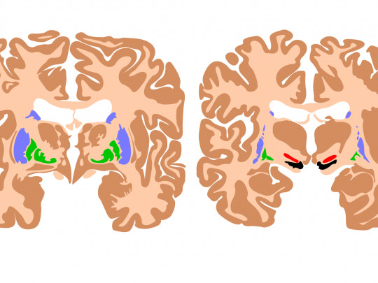 Tiramina: características de este neurotransmisor de tipo monoamina
