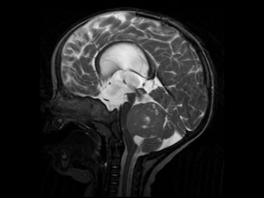 Paratonía: causas, síntomas y tratamiento