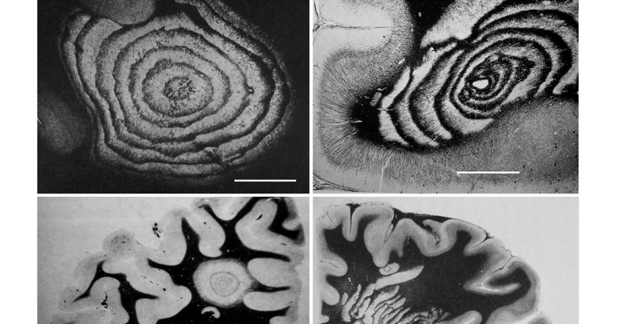 Enfermedad de Baló: síntomas, causas y tratamiento