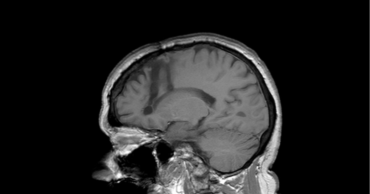 Los efectos de la lobotomía cerebral: un resumen