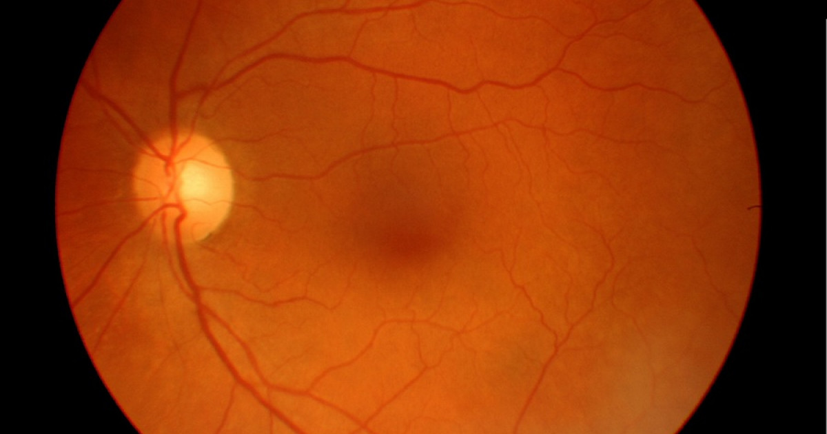 Degeneración macular: tipos, síntomas y tratamiento