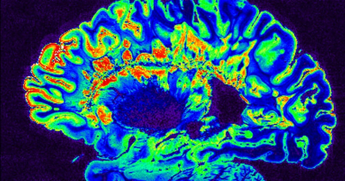 Neurobiología del TDAH: las bases cerebrales de este trastorno