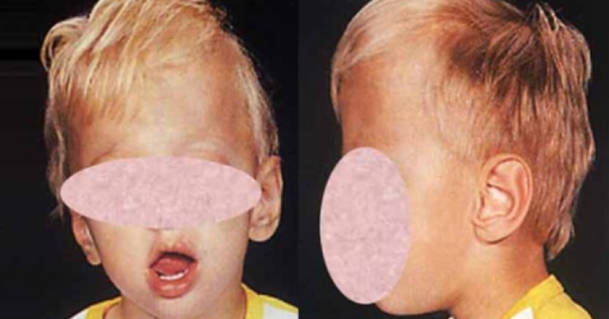 Macrocefalia: causas, síntomas y tratamiento