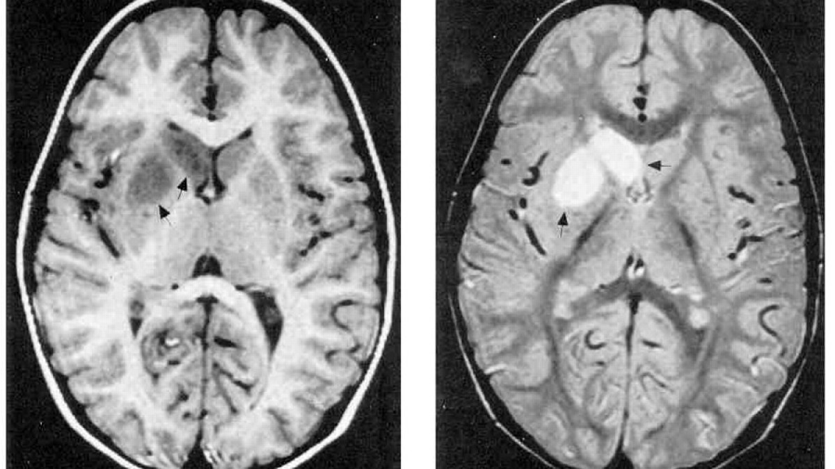 Corea Fiebre Reumática