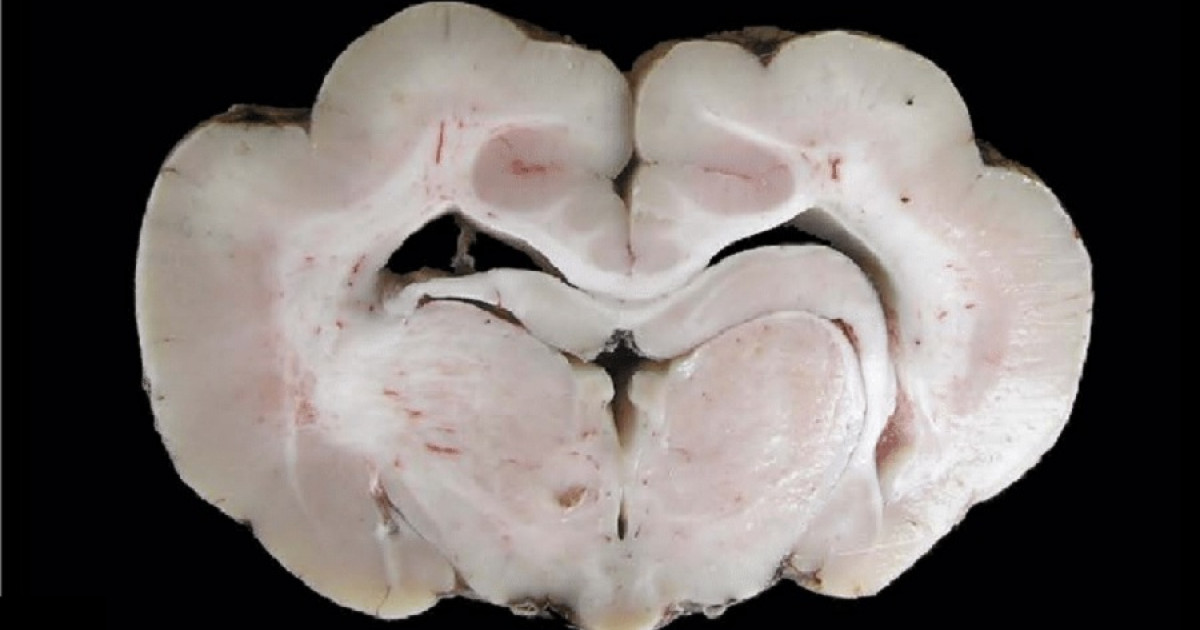Paquigiria: qué es, y efectos en la salud de esta malformación
