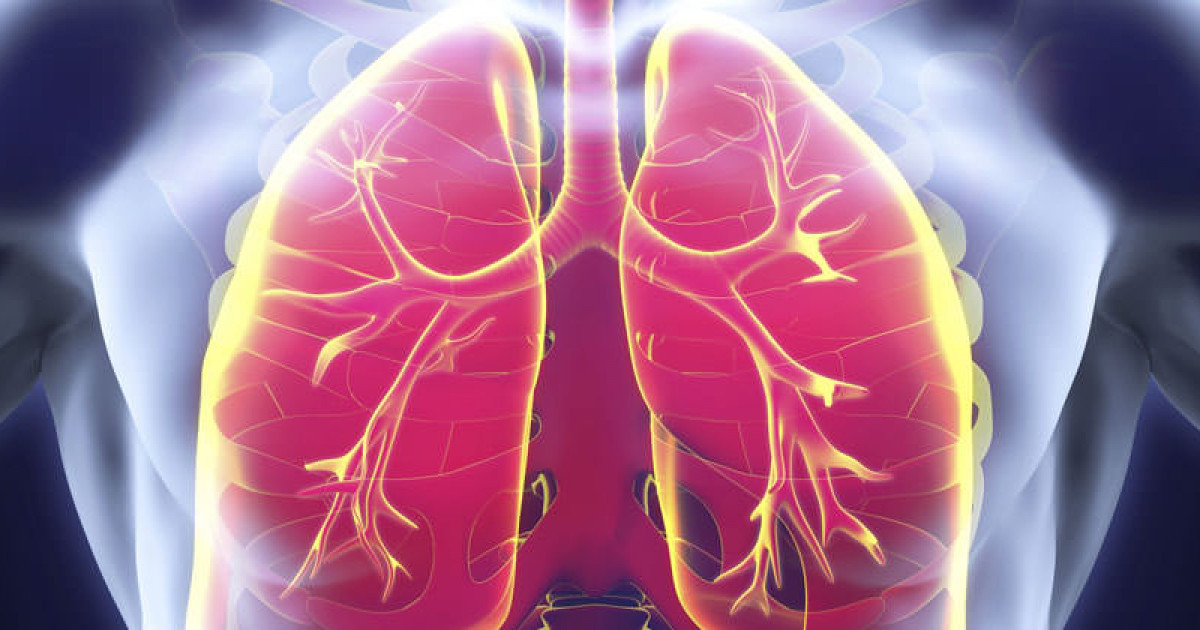 Los 9 tipos de Neumonía (causas, síntomas y tratamiento)