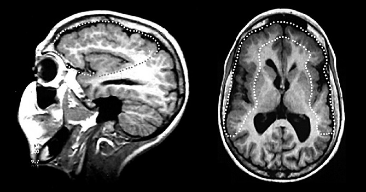 Polimicrogiria: causas, síntomas y efectos