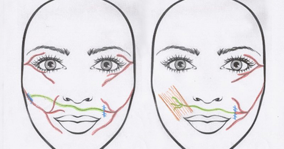 Síndrome de Ramsay Hunt: causas, síntomas y tratamiento