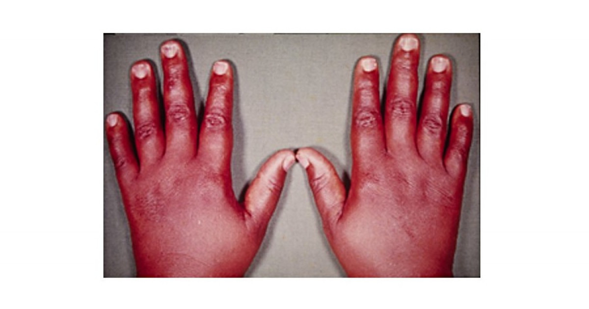 Mixedema: qué es, características y síntomas asociados