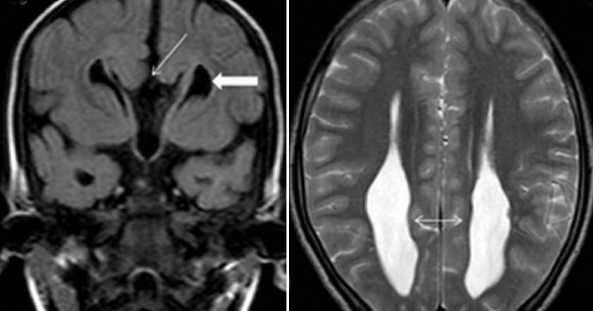 Colpocefalia: qué es, causas, síntomas y tratamiento